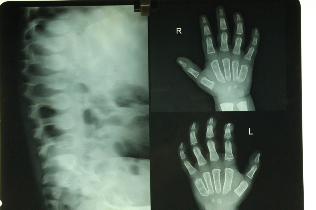 mps 1 hand - Dr. Vasu