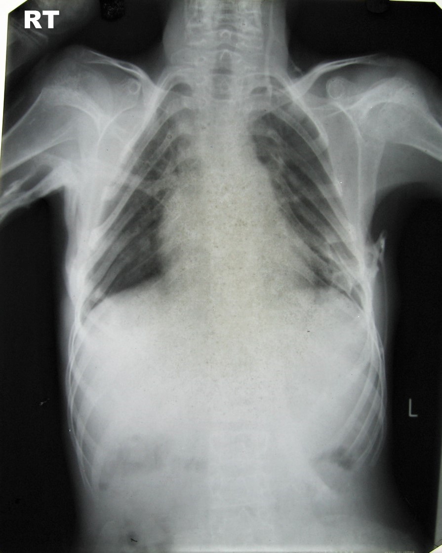 Fibrodysplasia Ossificance progressiva ( Munch Meyer’s disease)- Case ...